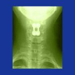 Anterior Cervical Fusion - Neck Pain