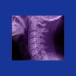 Neck X-Ray - Neck Pain