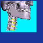 Reversal of Cervical Lordosis - Neck Pain