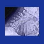 Rheumatoid Arthritis in the Neck - Neck Pain